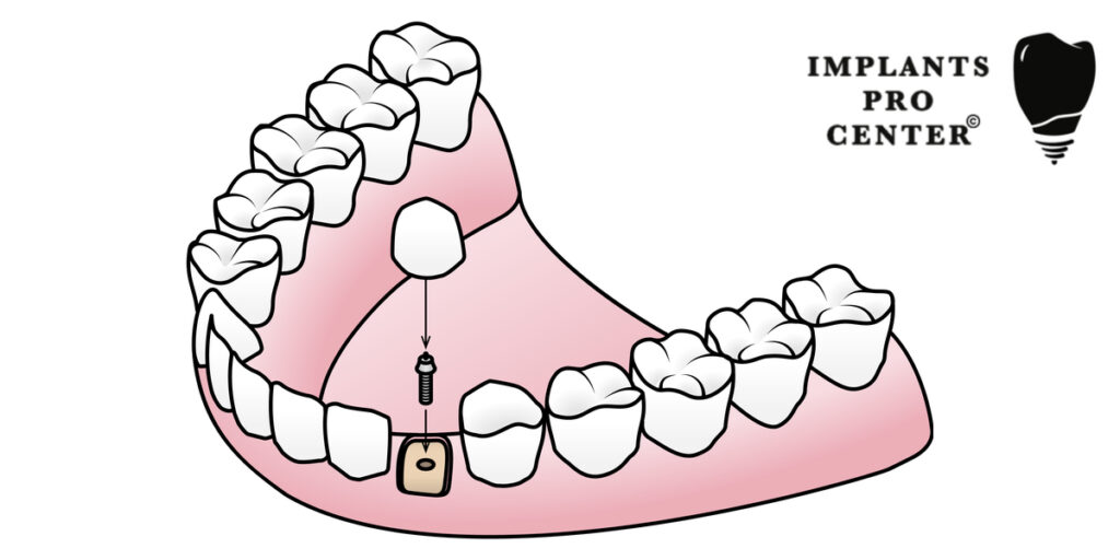 Endosteal Dental Implants - Process | Care | Criteria | Alternatives ...